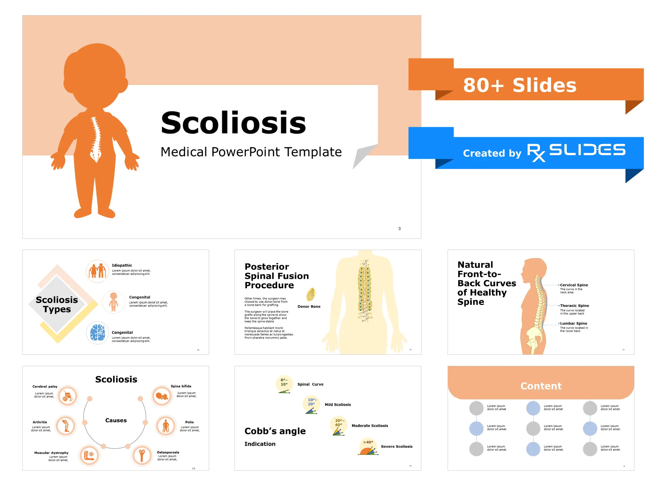 Download Scoliosis PowerPoint Template| RxSlides